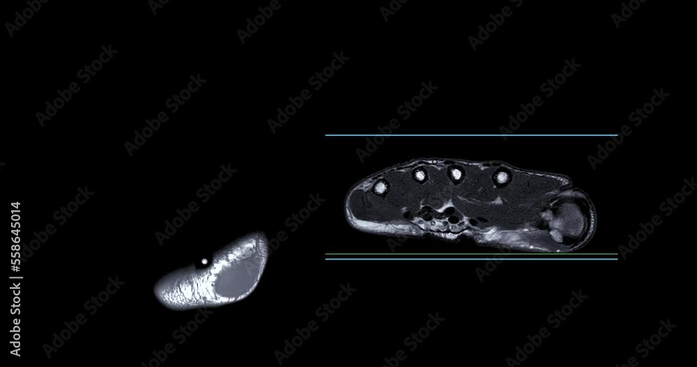 MRI hand T2W Fat suppression for diagnosis bone arthritis , rheumatoid ...