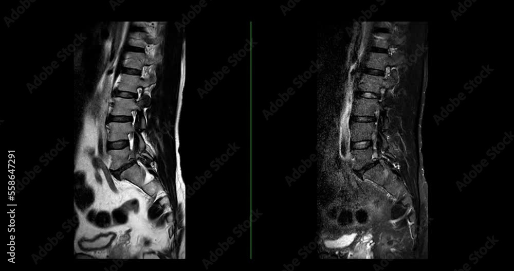MRI L-S spine or lumbar spine sagittal T2W and T2W Fat suppression for ...