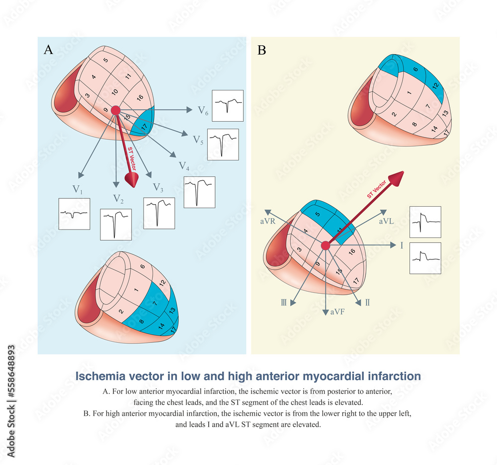 Fototapeta The anterior wall myocardial infarction in different parts ...