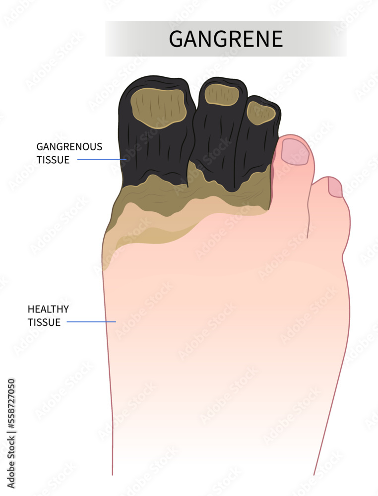 Foot cell bacteria traumatic fungus syndrome and diabetic sunburn of ...
