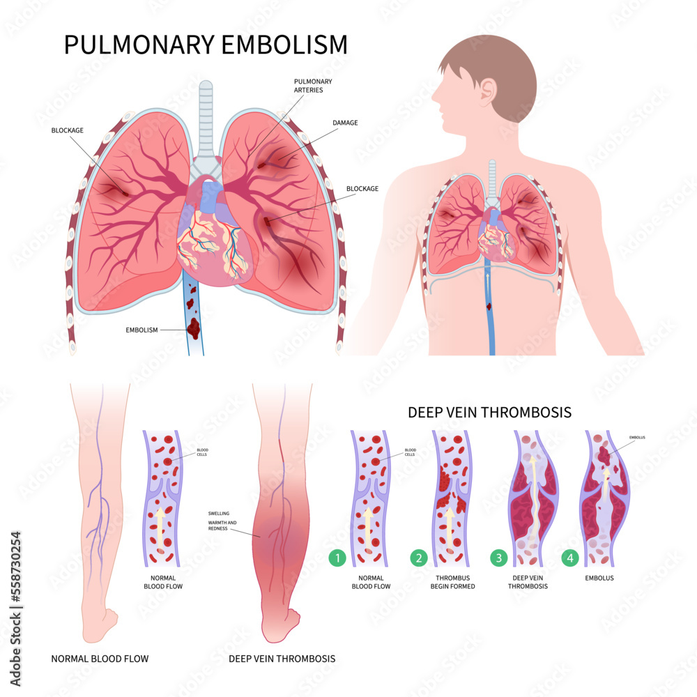 Swelling of lung blood vessel arteries clot chronic cough chest pain ...