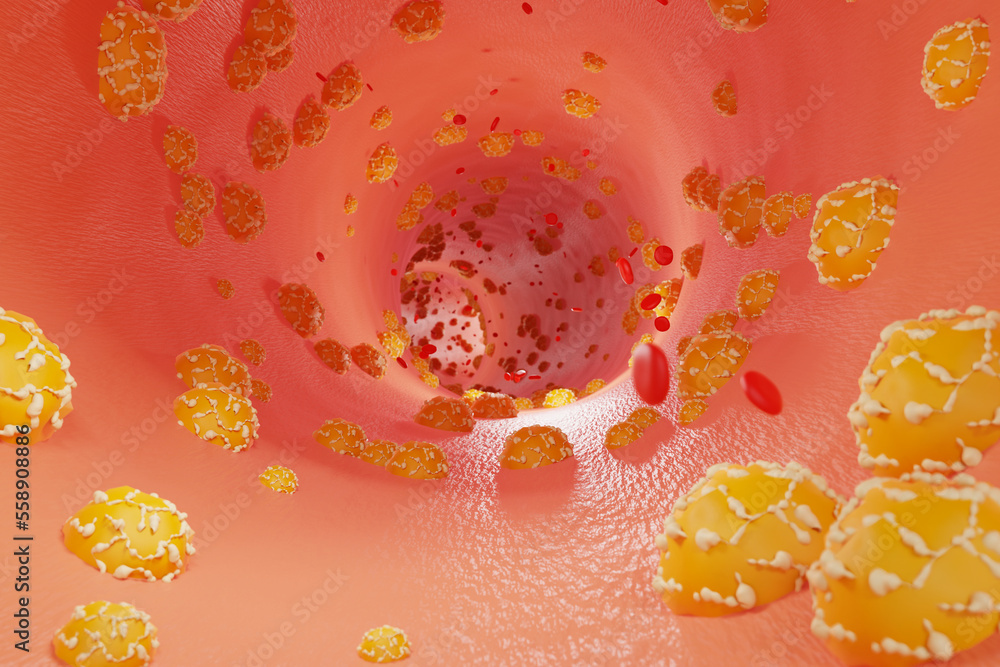Hyperlipidemia concept. Fat deposits in blood vessels and red blood ...