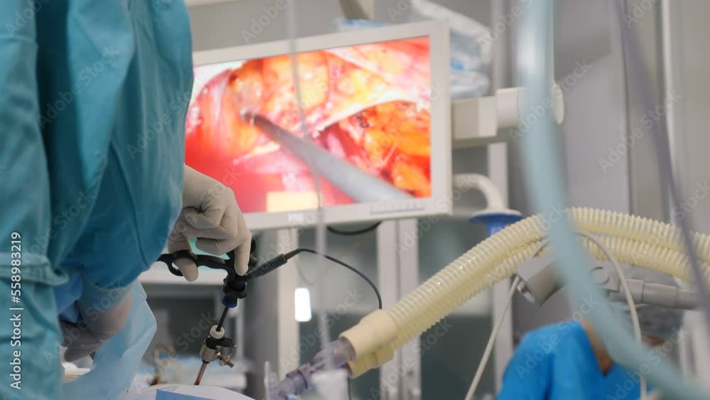 In operating room, laparoscopy. abdominal incision, working with ...