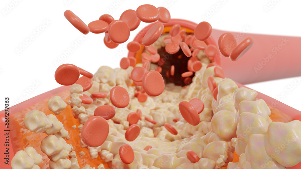 health care and medical concept with hyperlipidemia. Hyperlipidemia ...