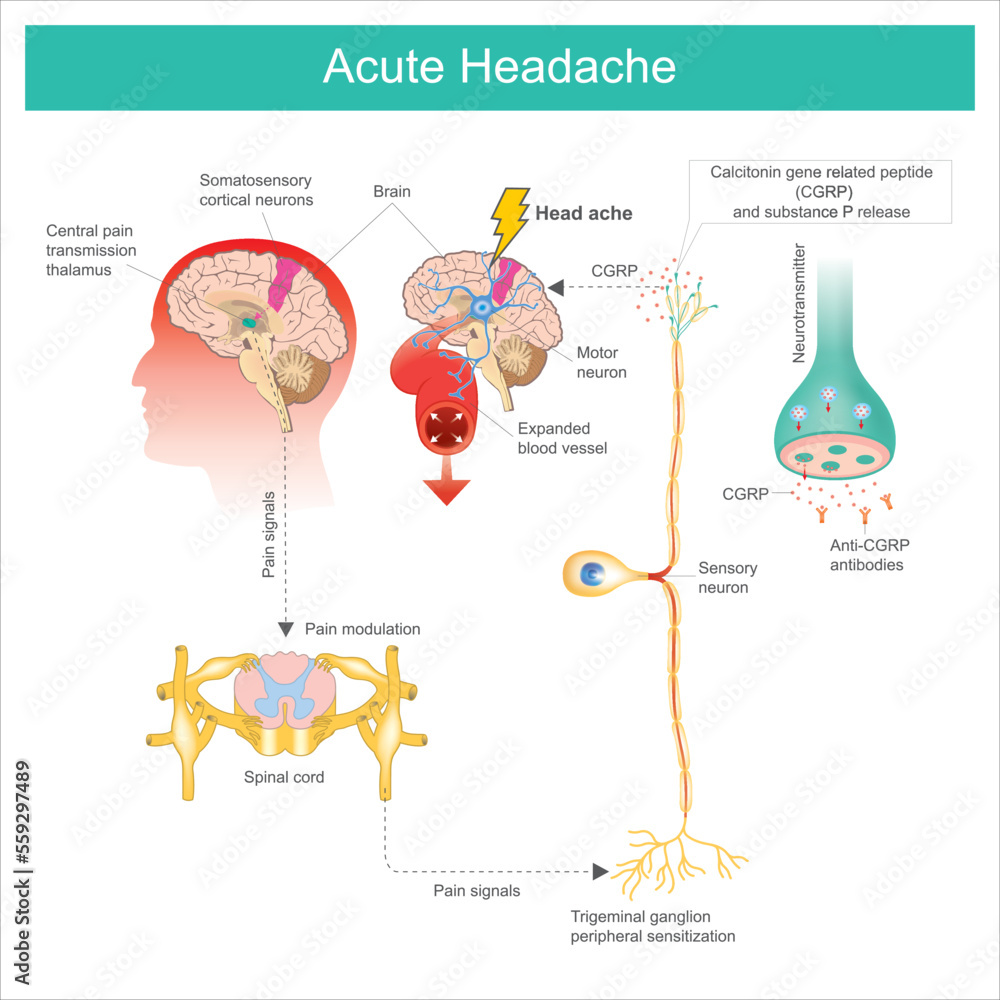 Acute Headache. Diagram learning The Acute Headache as a result a ...