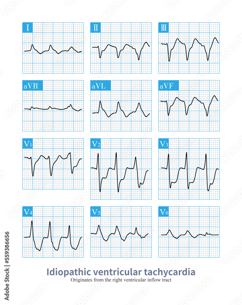 The electrocardiogram is an idiopathic ventricular tachycardia ...