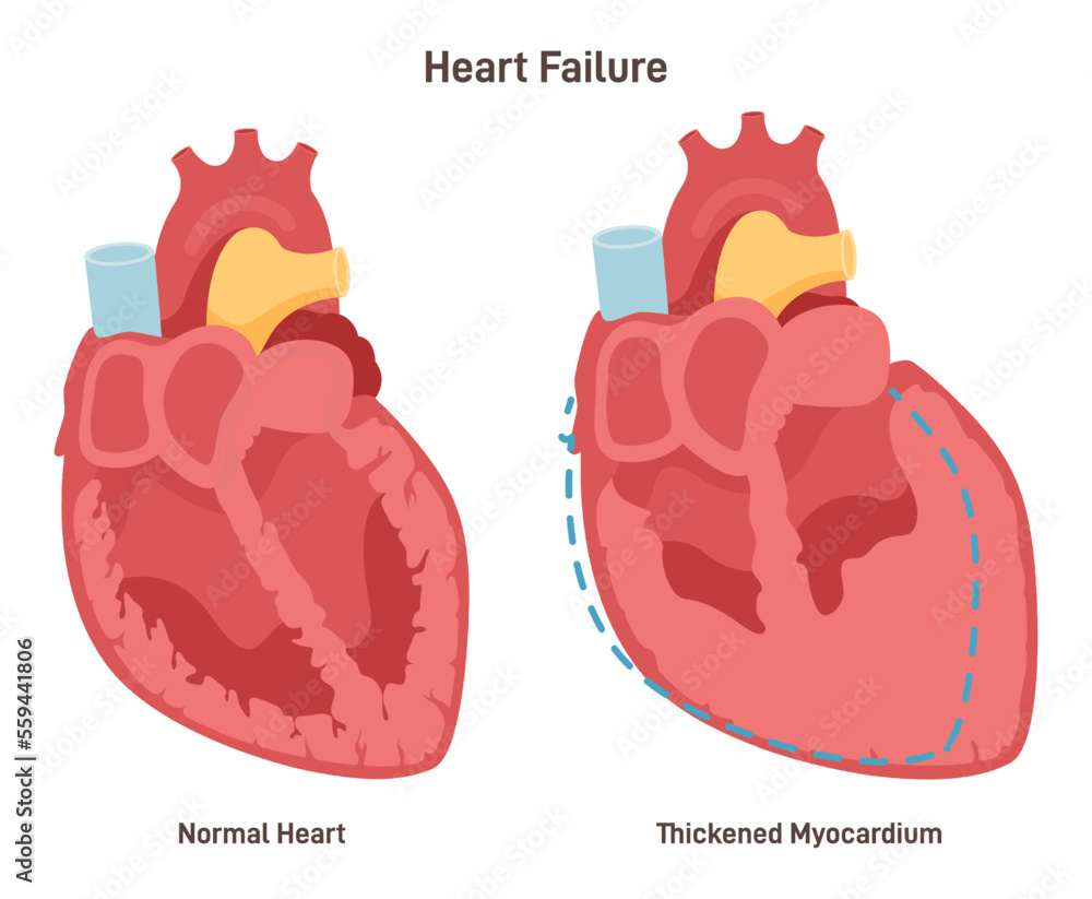 Heart failure, impairment of the blood pumping function. Healthy heart ...
