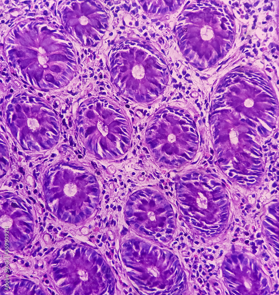 Transverse colon microscopic image seen atypical cell, colonic mucosa ...