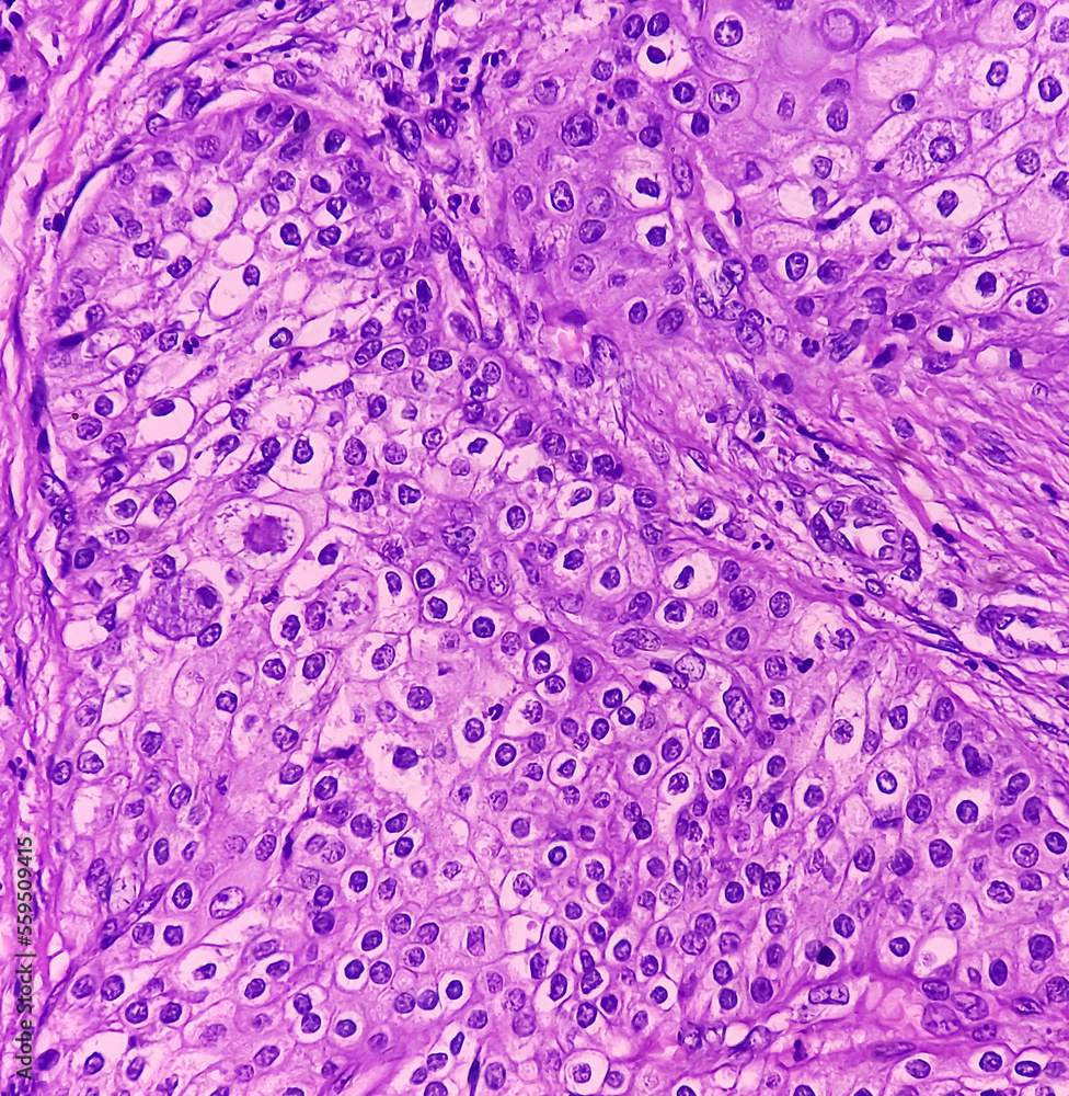 High grade mucoepidermoid carcinoma of parotid cyst. Microscopic show ...