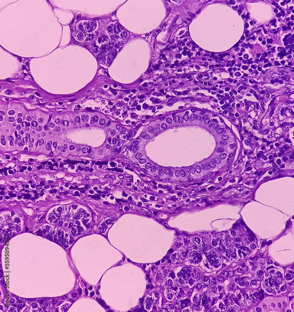 High grade mucoepidermoid carcinoma of parotid cyst. Microscopic show ...