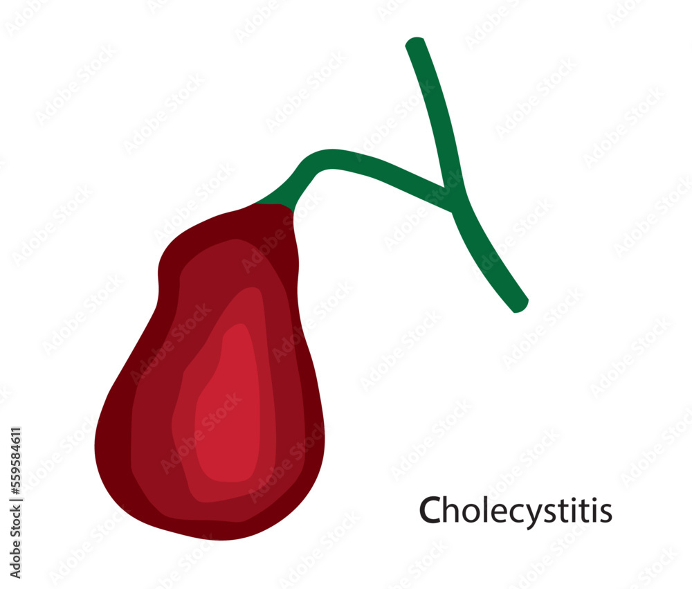 Cholecystitis - gallbladder organ inflammation illustration Stock ...