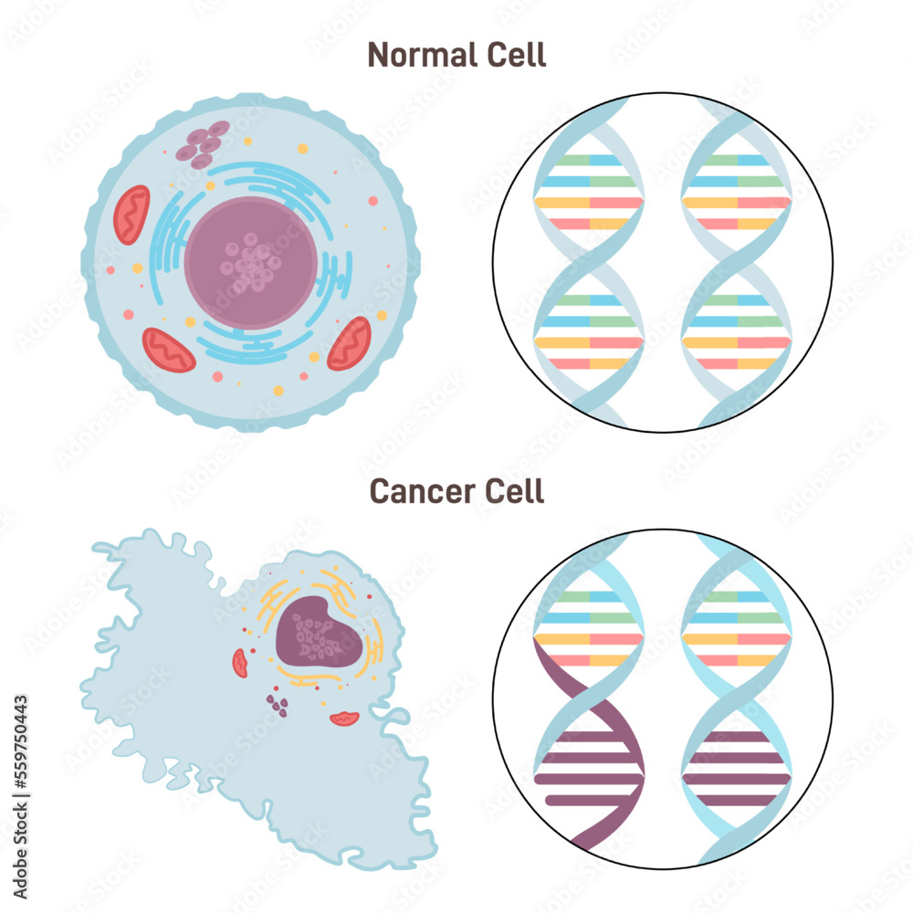 Normal and cancer cells. Difference between healthy tissue and tumor ...