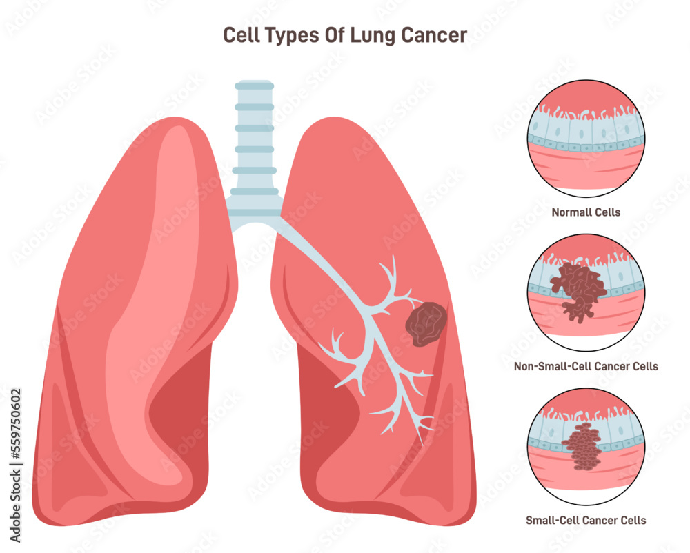 Lung cancer cell types. Pathological malignant cells or tumor located ...