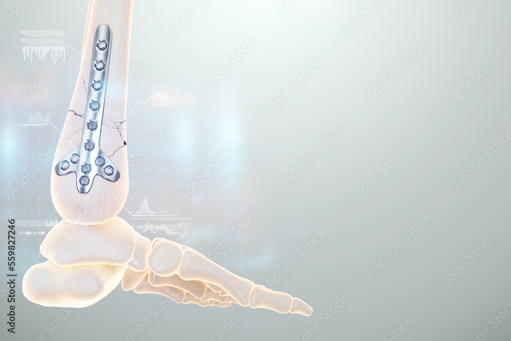 Medical procedure, osteosynthesis operation, surgical repositioning of ...