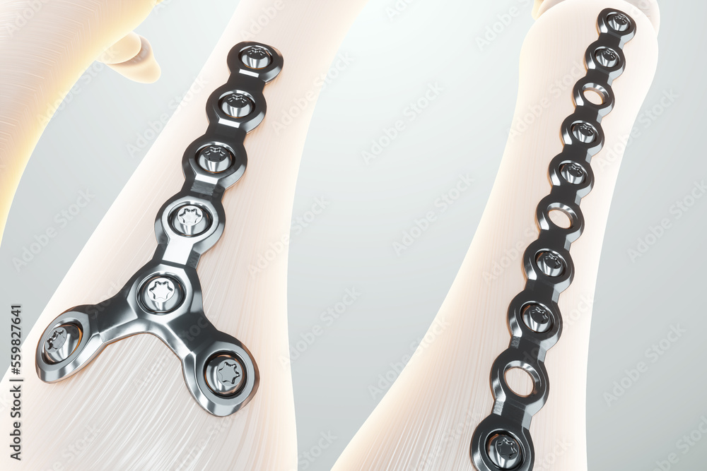 Medical procedure, osteosynthesis operation, surgical repositioning of ...