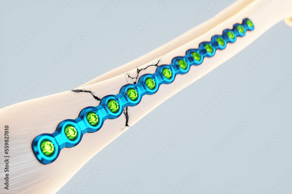 Medical procedure, osteosynthesis operation, surgical reposition ...