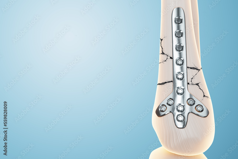 Medical procedure, osteosynthesis operation, surgical repositioning of ...