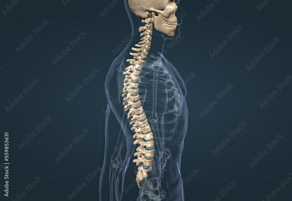 People with scoliosis have a sideways curve in the spine Stock ...