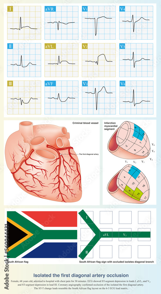 When the isolated first diagonal artery is occluded, ECG can show ST ...