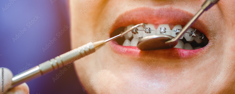 Dental braces in happy womans mouths on brackets on the teeth after ...