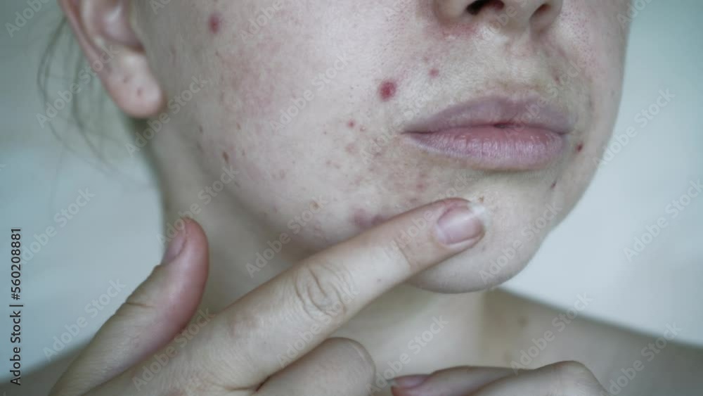 Close up of skin problems, unhealthy skin with acne and pimples. Porous ...