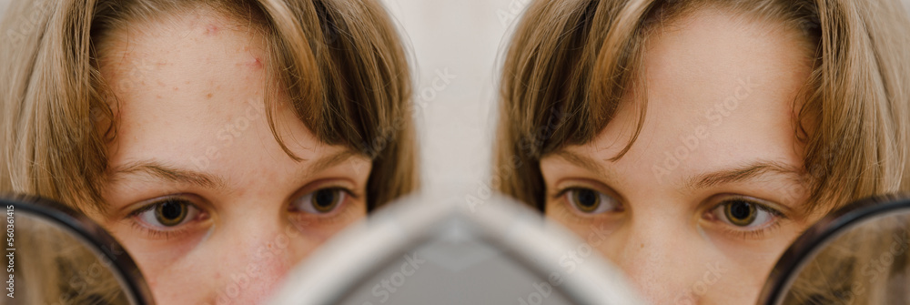 Teenager boy face before and after skin care treatment Stock Photo ...