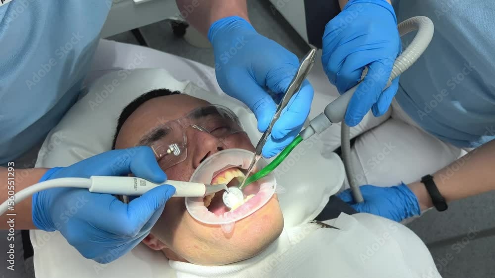 teeth cleaning middle-aged man plaque calculus in mouth lip and cheek ...