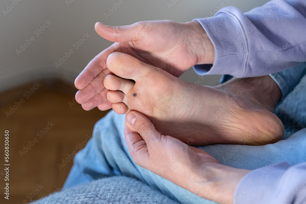 Man checks wart at home after cauterizing it with celandine on infected ...