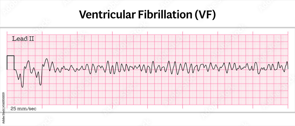 ECG Ventricular Fibrillation (VF) - 8 Second ECG Paper - JPG format - Medical Illustration Stock ...
