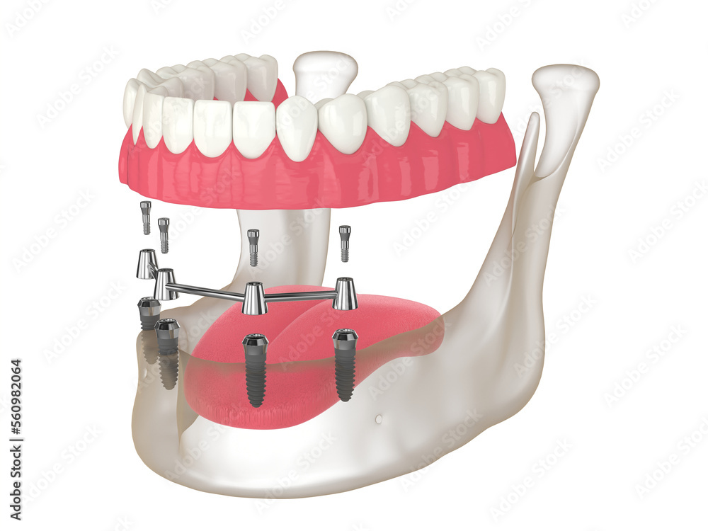 3d render of bar retained removable overdenture installation supported ...