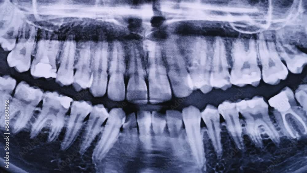 Stockvideon X-ray image of the jaw of all human teeth close-up ...