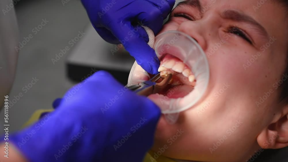 Close-up of a real procedure for extracting a molar baby tooth that ...