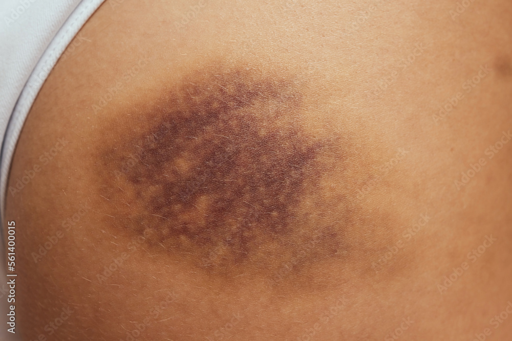 Hematoma and Large Bruise, blood under skin Congestion. Stock Photo ...