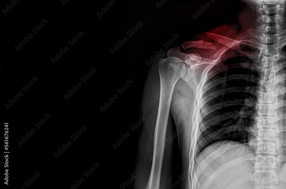 Fracture clavicle.Plain radiograph of human shoulder after accident.The ...