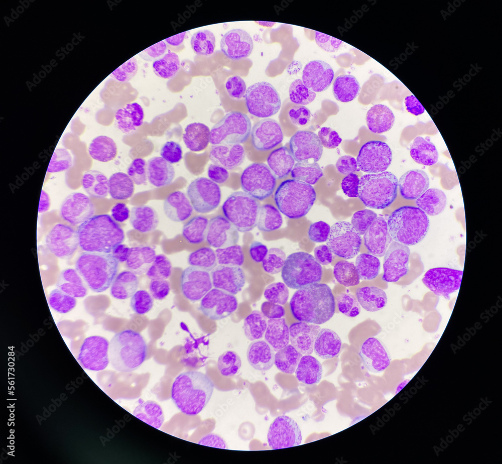 Blood smear leukaemia white blood cells blast. Stock Photo | Adobe Stock