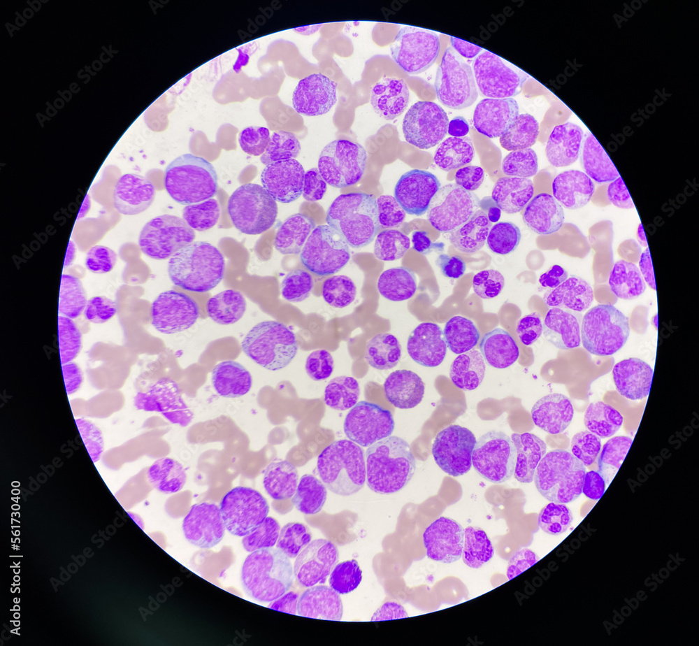 Blood smear leukaemia white blood cells blast. Stock Photo | Adobe Stock