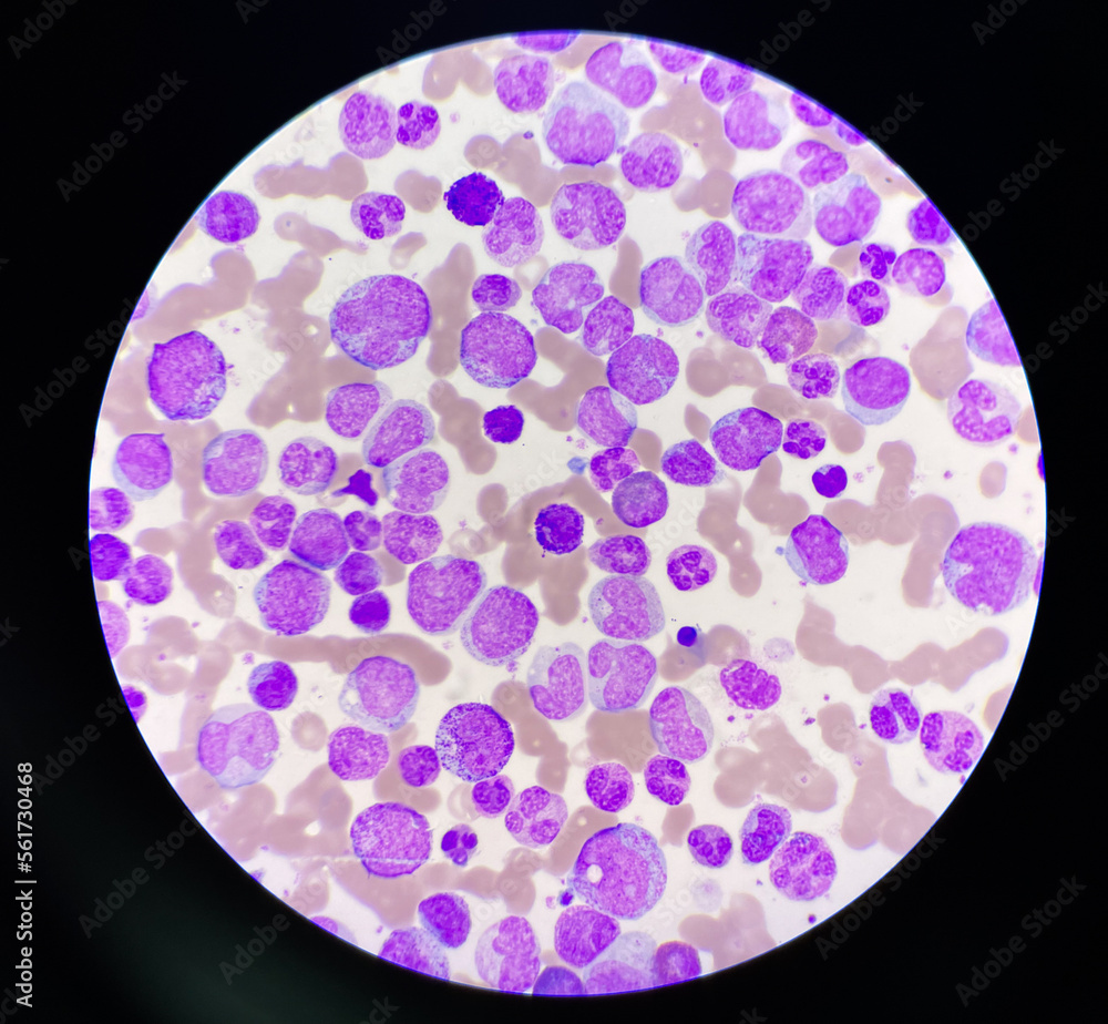 Blood smear leukaemia white blood cells blast. Stock Photo | Adobe Stock
