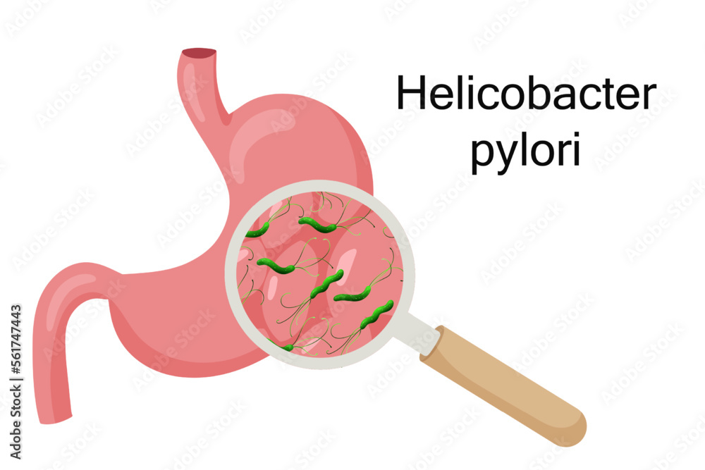 Gastritis with helicobacter pylori under magnifying glass. Vector ...