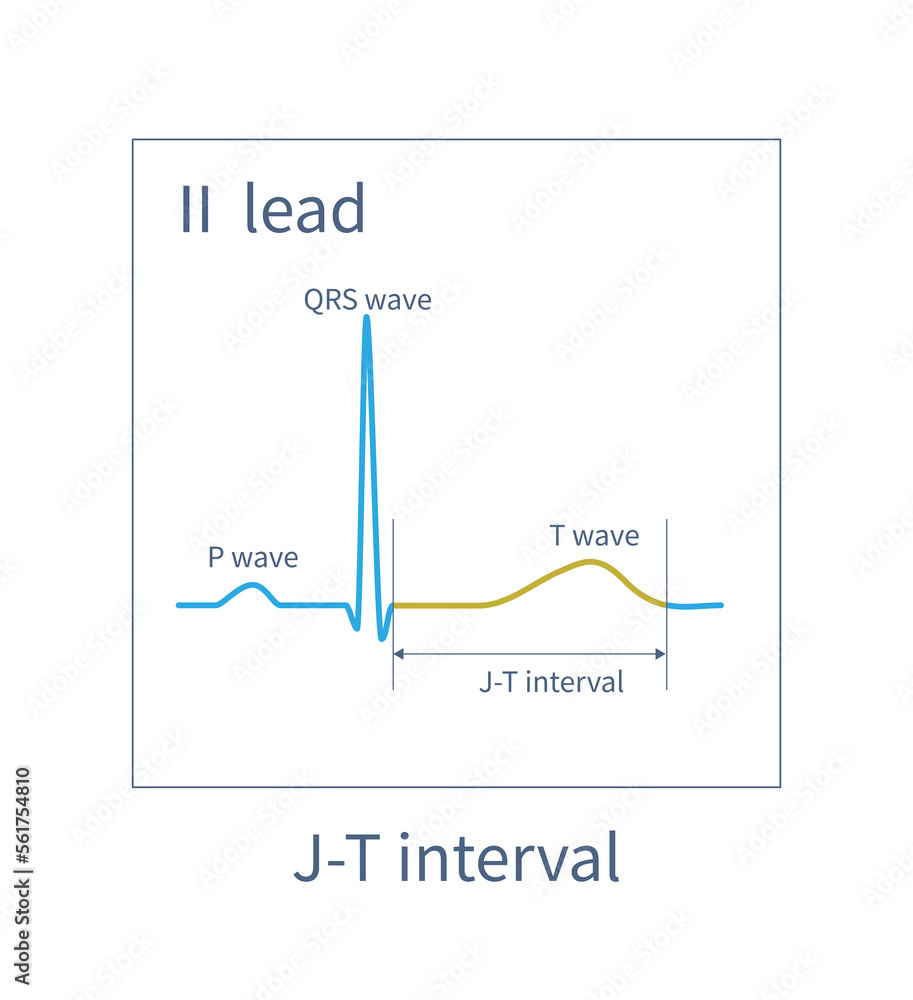 The JT interval is the time interval from the J point or the start of ...