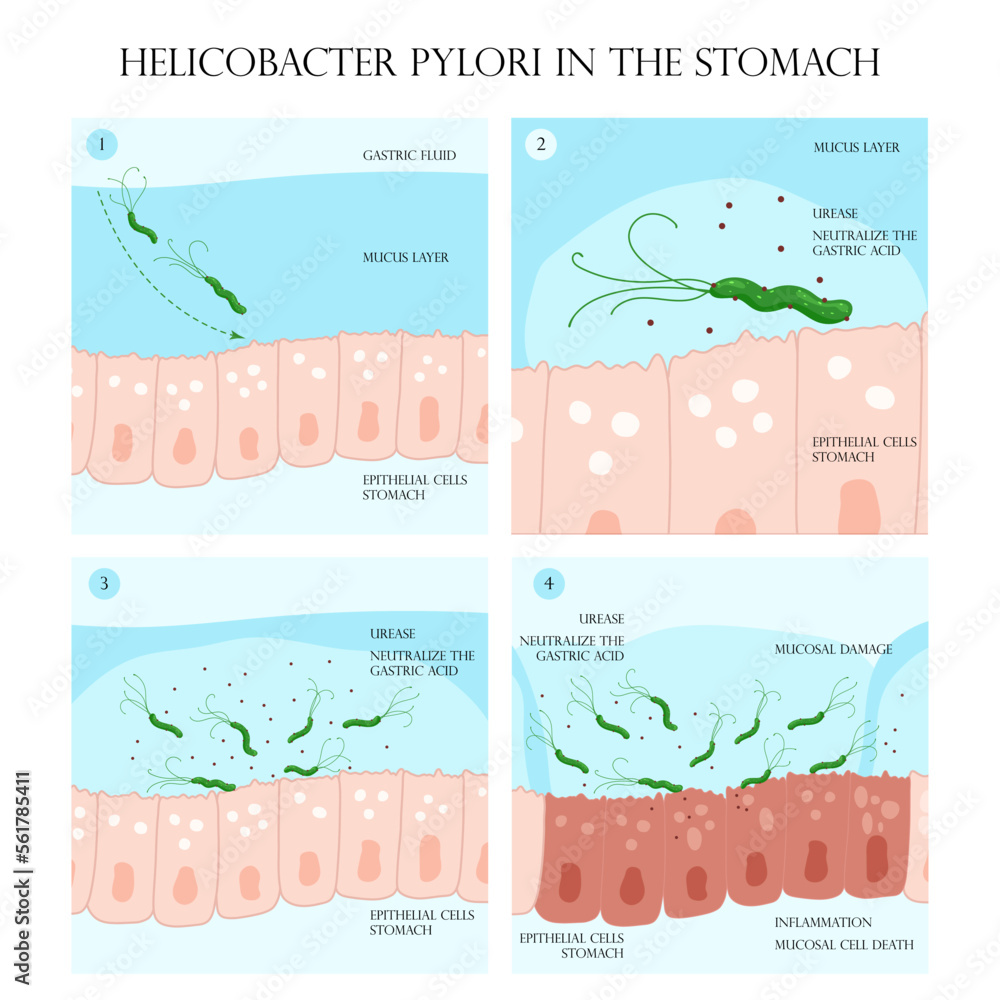 Helicobacter pylori infection process in stomach mucosal layer ...