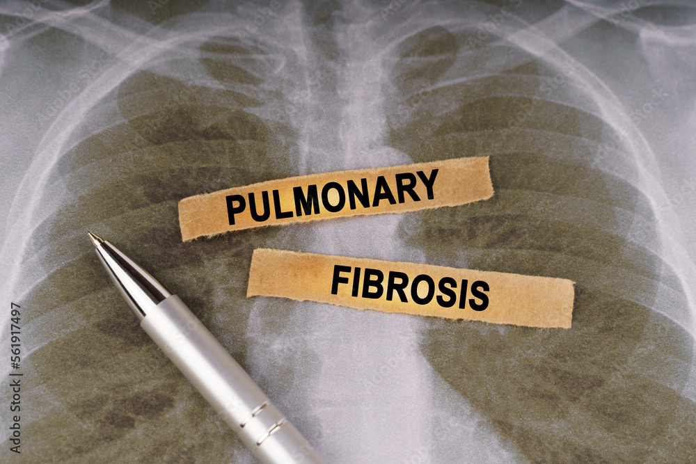 On a human chest x-ray, a pen and strips of paper labeled - pulmonary ...