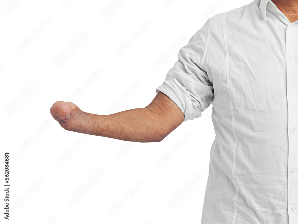 Disability, amputee and arm of a man with a disability showing forearm ...