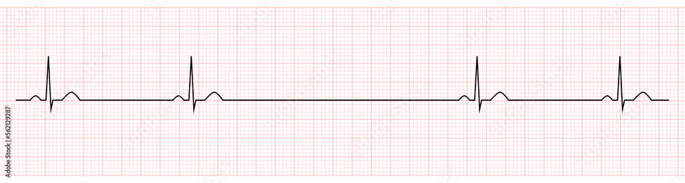EKG Showing Sinus Bradycardia with pause of Patient Stock Vector ...