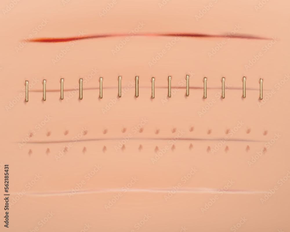 Realistic scars. Medical surgical sutures wounds close up pictures on ...