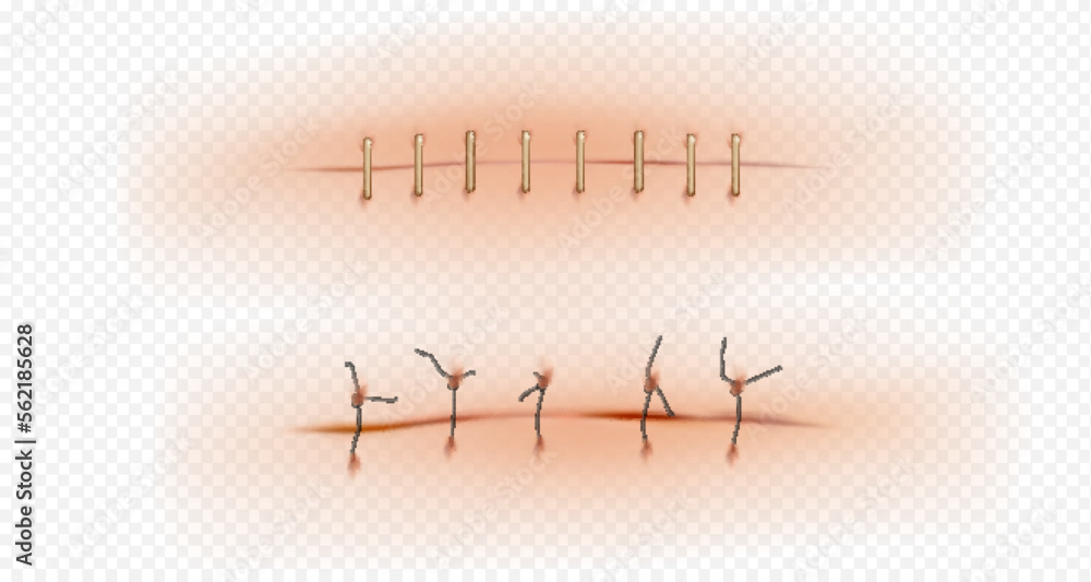 Realistic scars. Medical surgical sutures wounds close up pictures on ...