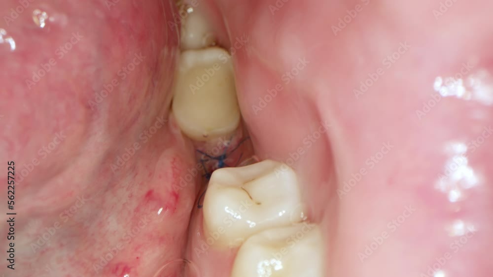 Close-up oral cavity of a patient who has just had a gum augmentation ...