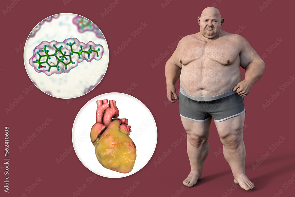 Molecule of cholesterol and obese heart in overweight man, 3D ...