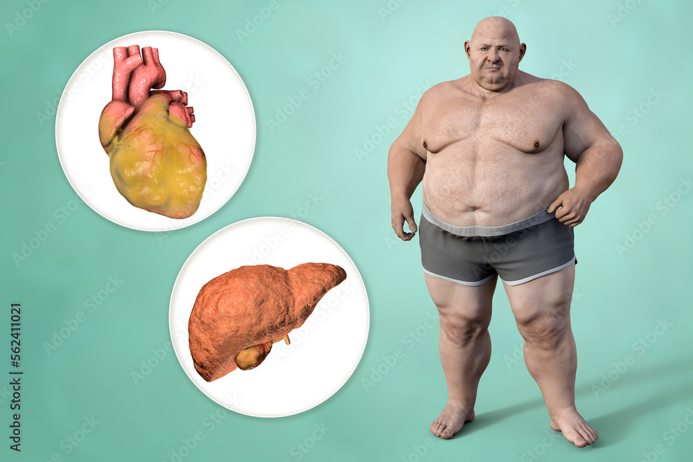 Obese heart and liver in overweight man, 3D illustration. Concept of ...