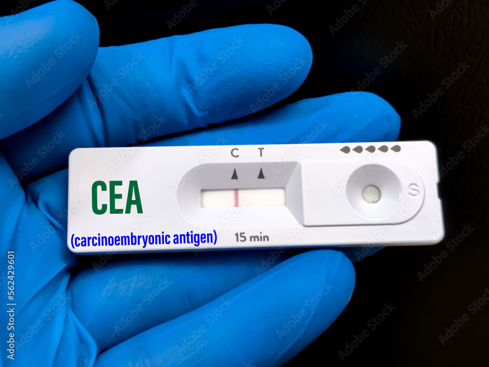 CEA (Carcinoembryonic antigen) testing by using test cassette, the ...