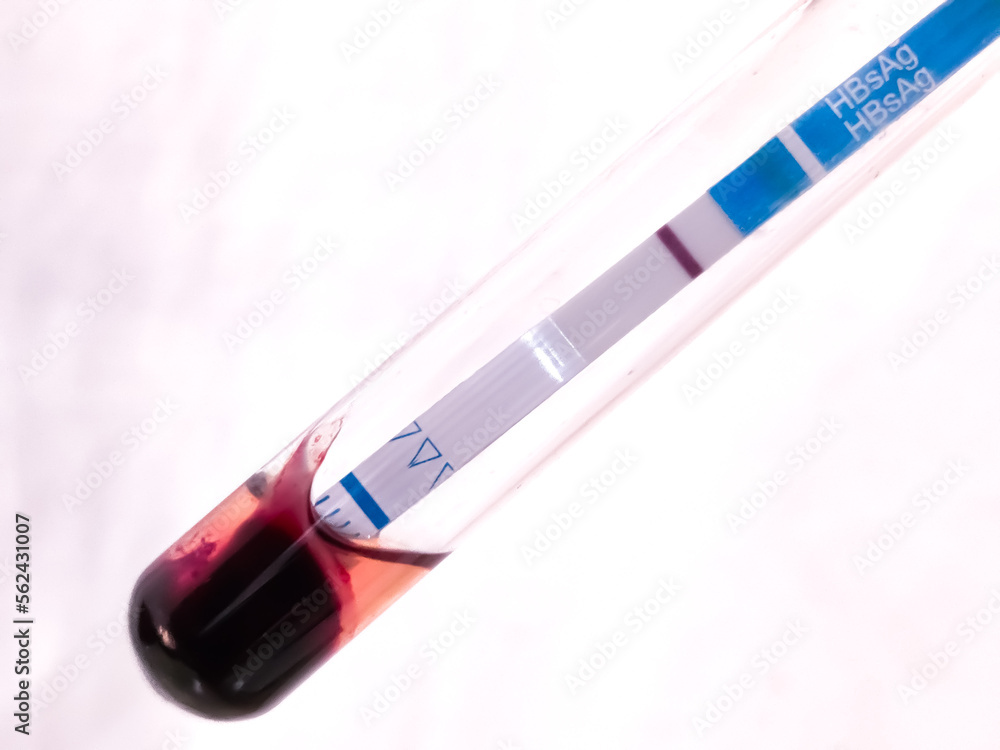 Foto de HBsAg Test Medical check up test, with whole blood sample and ...